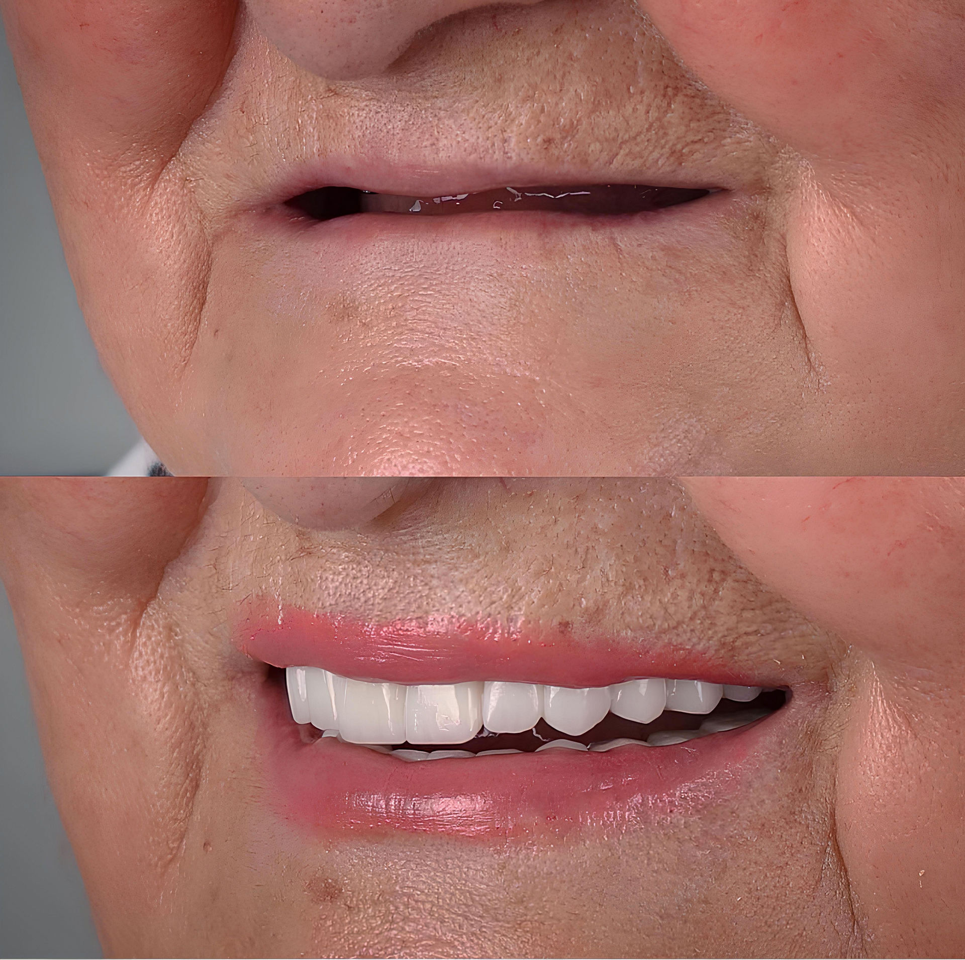 Full dentures - Best Budapest Dentist